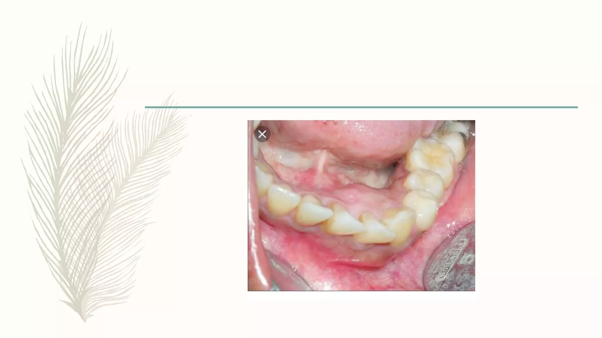 ossifying fibroma and cemental dysplasia | PPTX