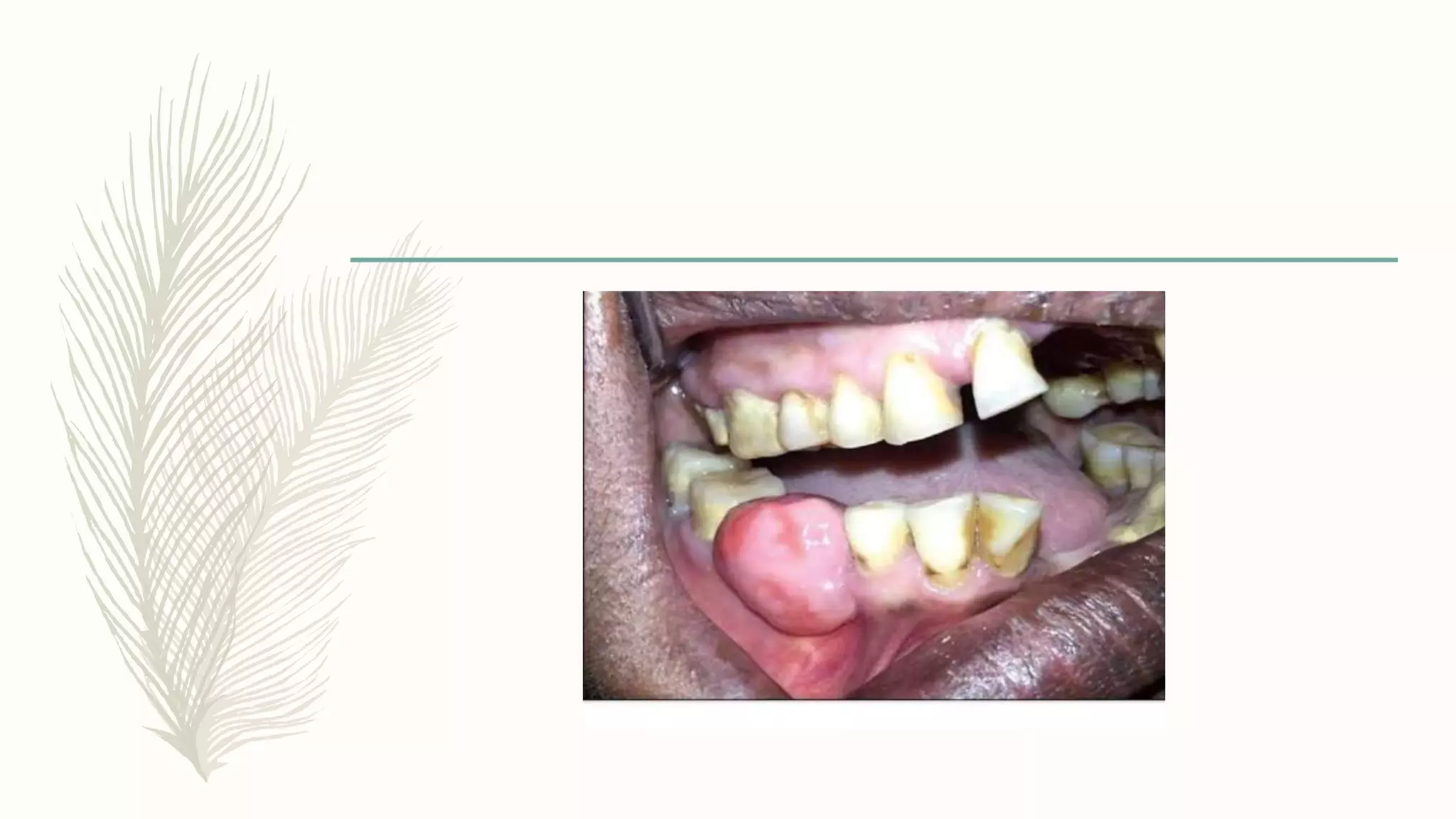 ossifying fibroma and cemental dysplasia | PPTX