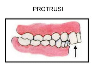 4.oklusi | PPT