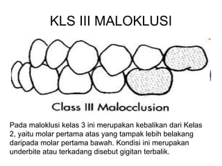 4.oklusi | PPT