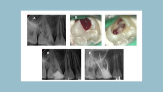 Endodontic emergencies | PPTX