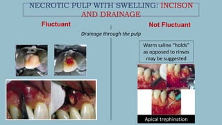 Endodontic emergencies | PPTX