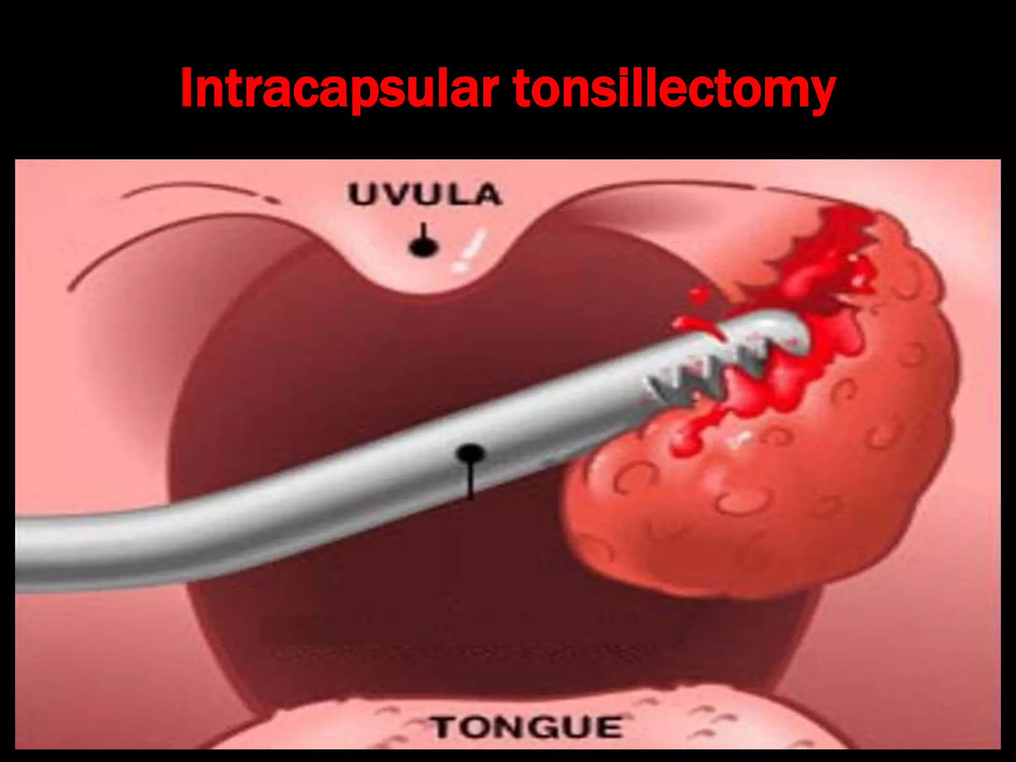 Tonsillectomy, adenoidectomy and quinsy | PPT