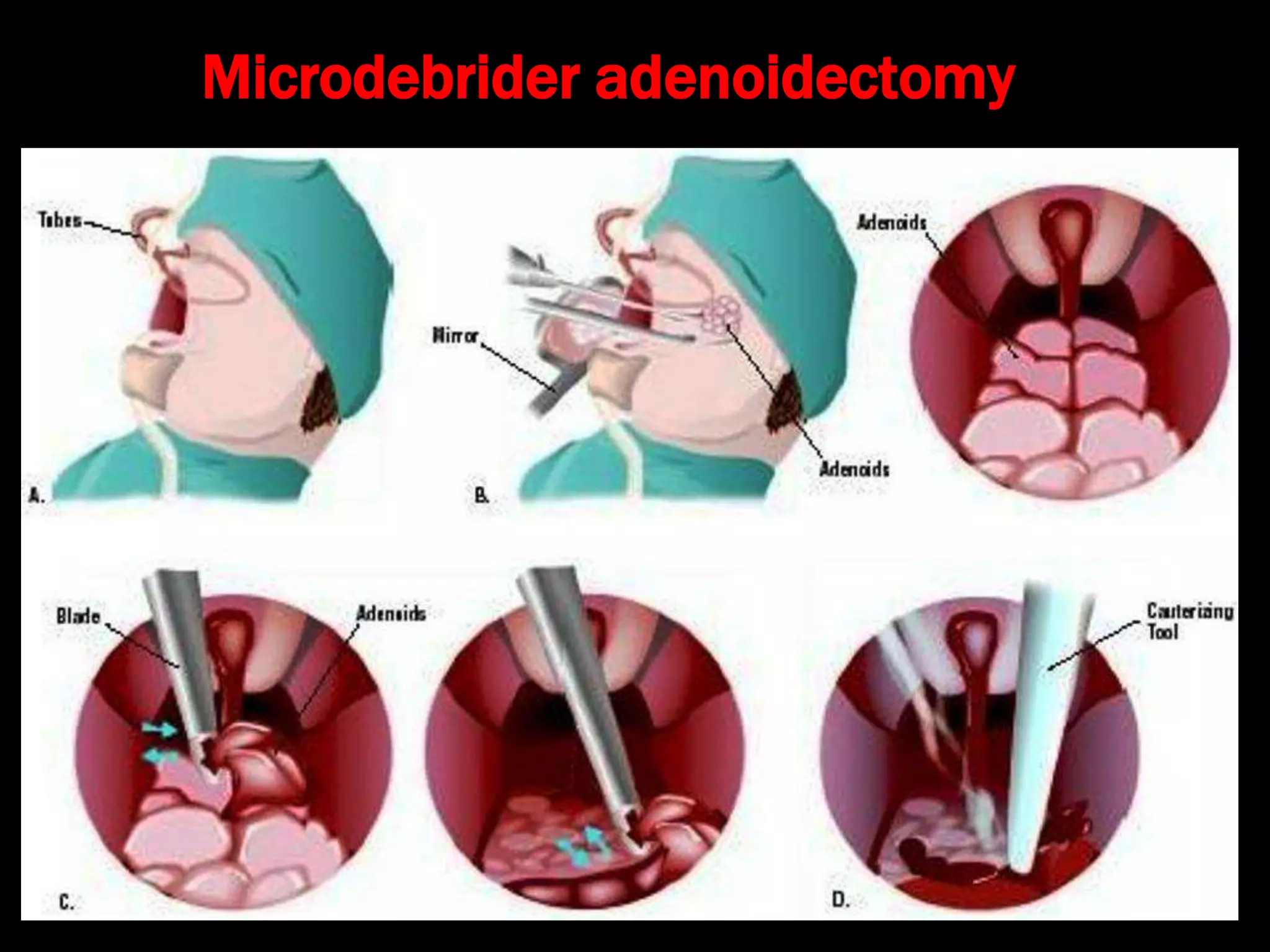 Tonsillectomy, adenoidectomy and quinsy | PPT