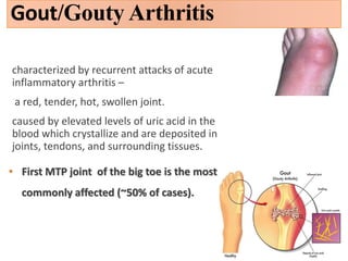 4.2 drugs in gout and RA | PPT