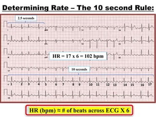 4. ecg basics rate and axis | PPTX | Heart and Cardiovascular Diseases ...