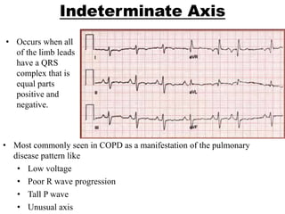 4. ecg basics rate and axis | PPTX | Heart and Cardiovascular Diseases ...