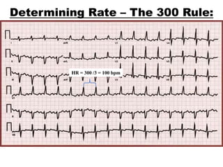 4. ecg basics rate and axis | PPTX | Heart and Cardiovascular Diseases ...