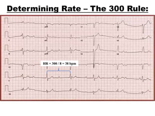 4. ecg basics rate and axis | PPTX | Heart and Cardiovascular Diseases ...