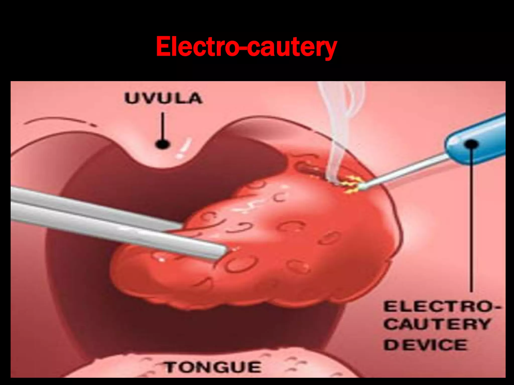4.tonsillectomy, adenoidectomy and quinsy | PPT