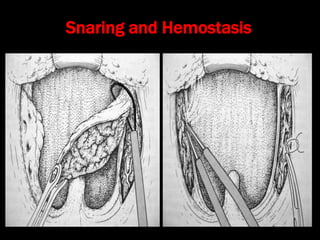4.tonsillectomy, adenoidectomy and quinsy | PPT