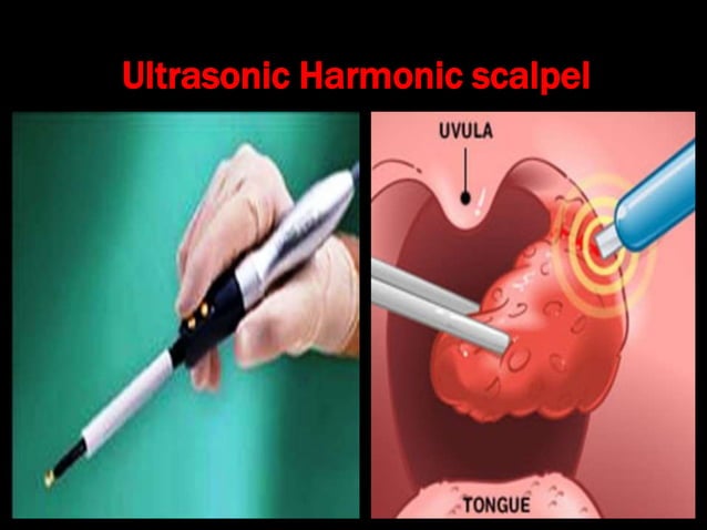 4.tonsillectomy, adenoidectomy and quinsy | PPT