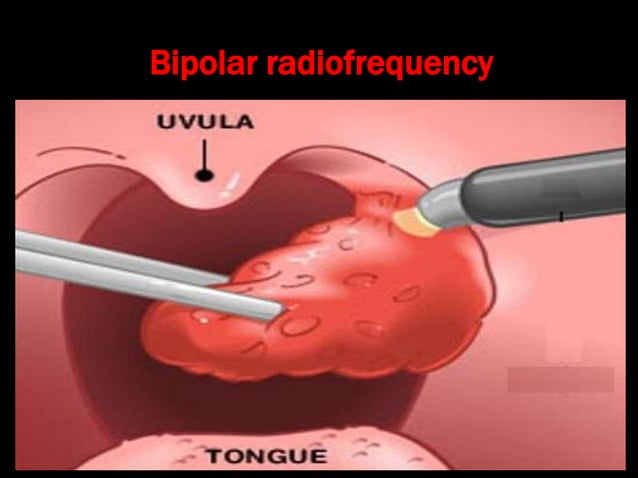 4.tonsillectomy, adenoidectomy and quinsy | PPT
