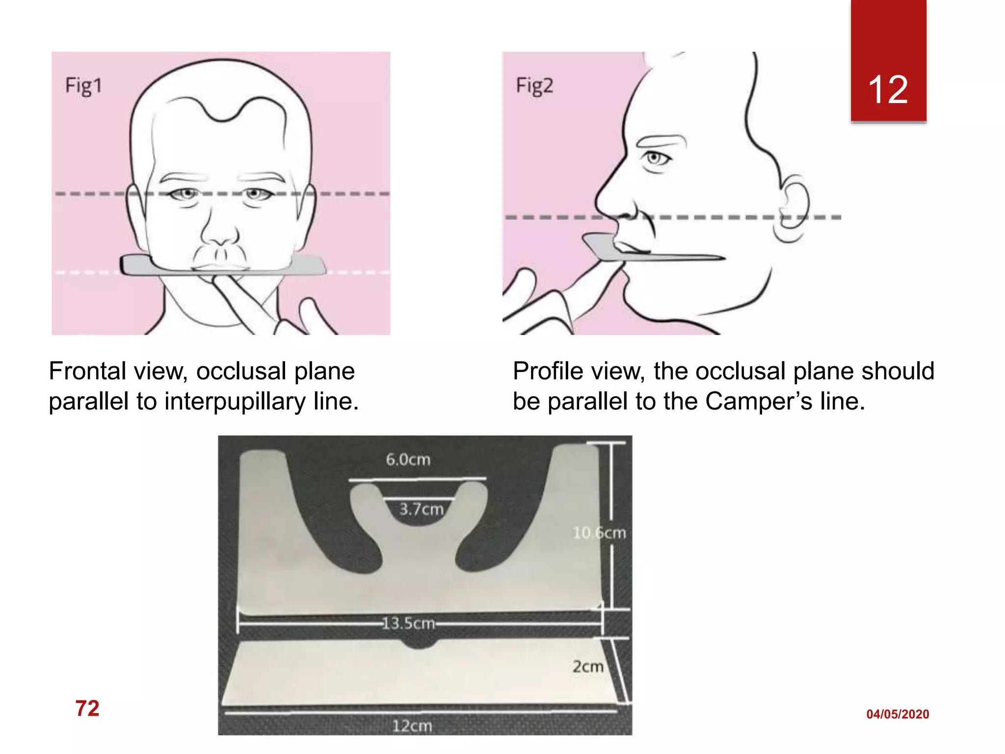 orientation jaw relation in complete denture fabrication | PPTX