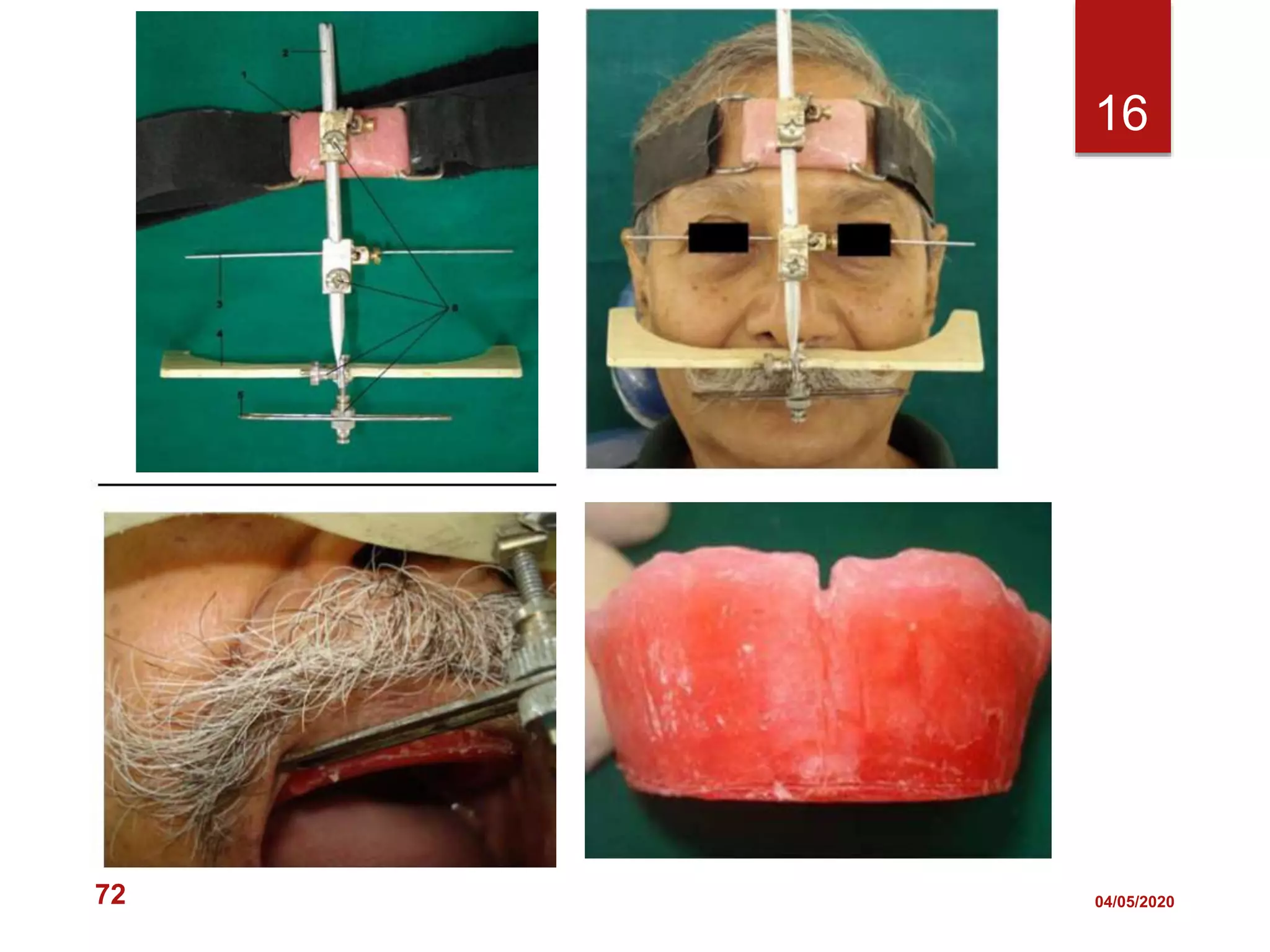 orientation jaw relation in complete denture fabrication | PPTX