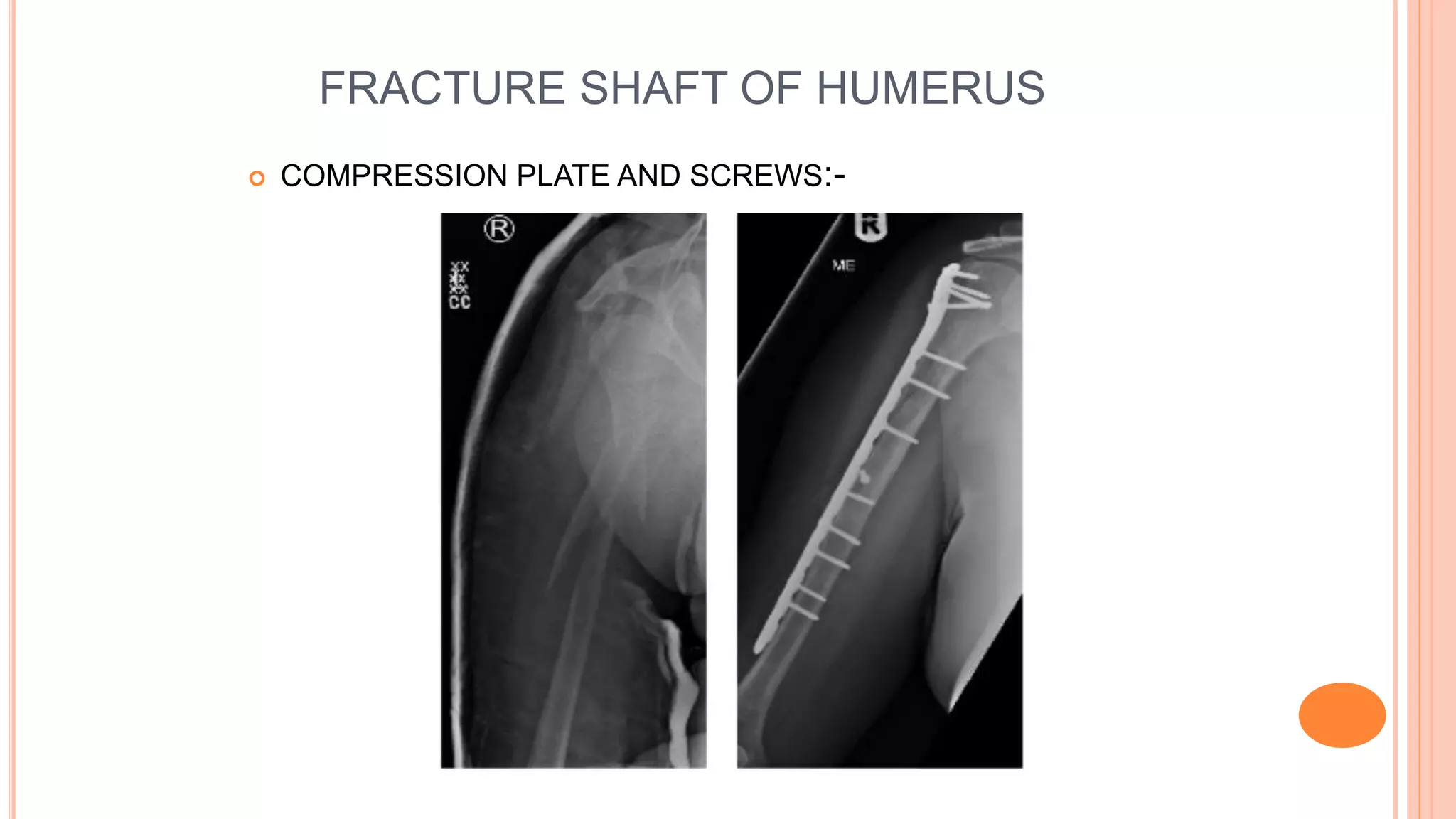 Shaft of humerus fracture | PPTX