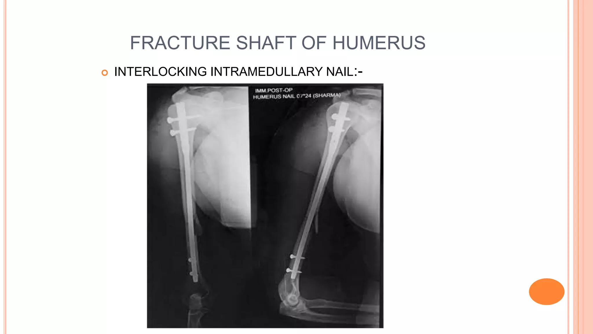 Shaft of humerus fracture | PPTX