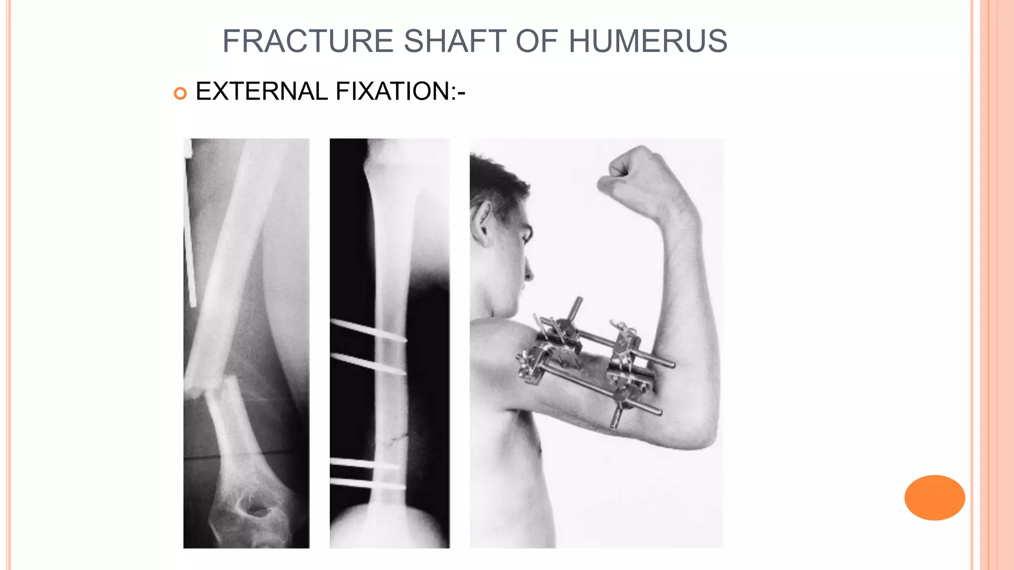 Shaft of humerus fracture | PPTX