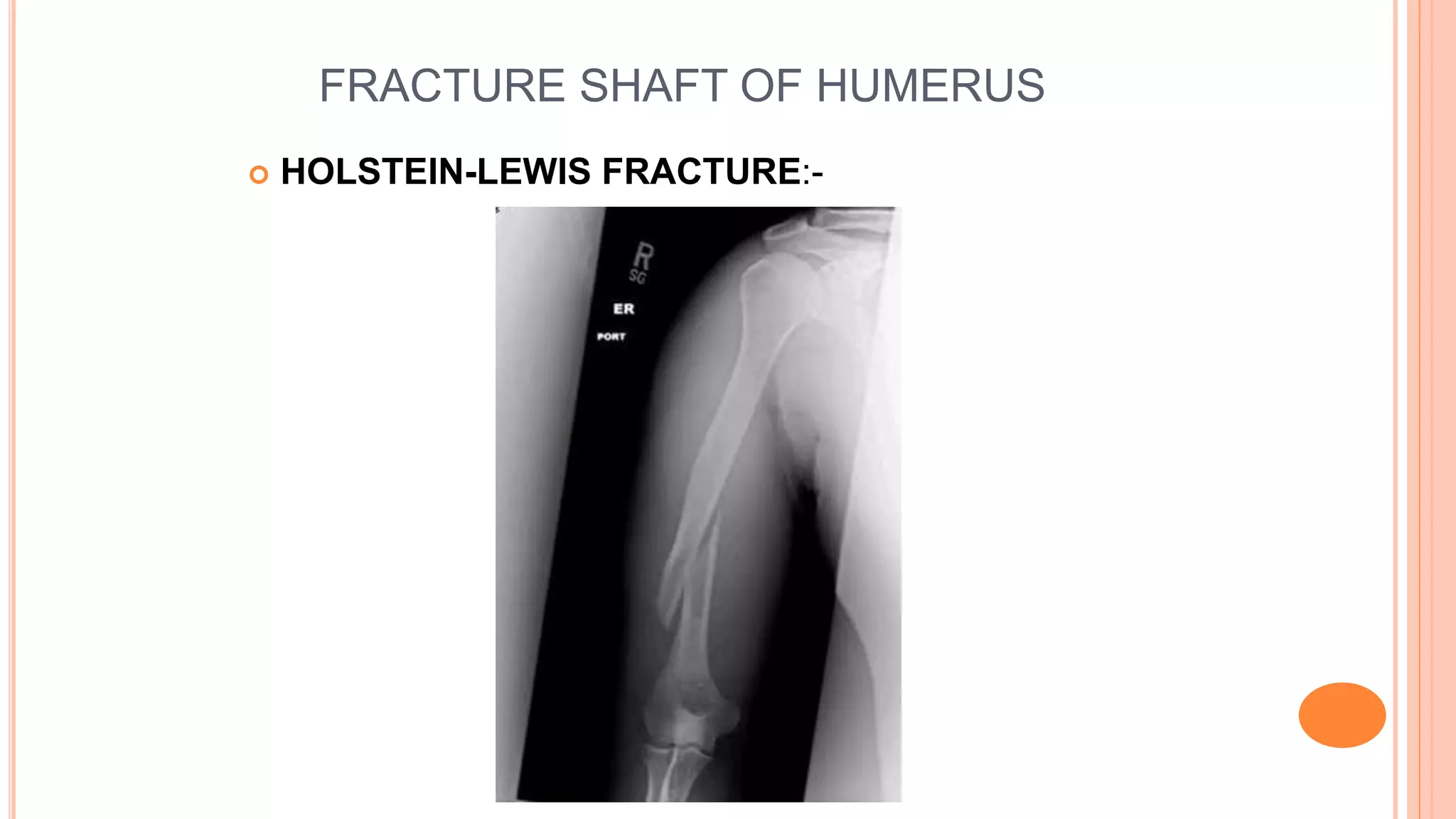 Shaft of humerus fracture | PPTX