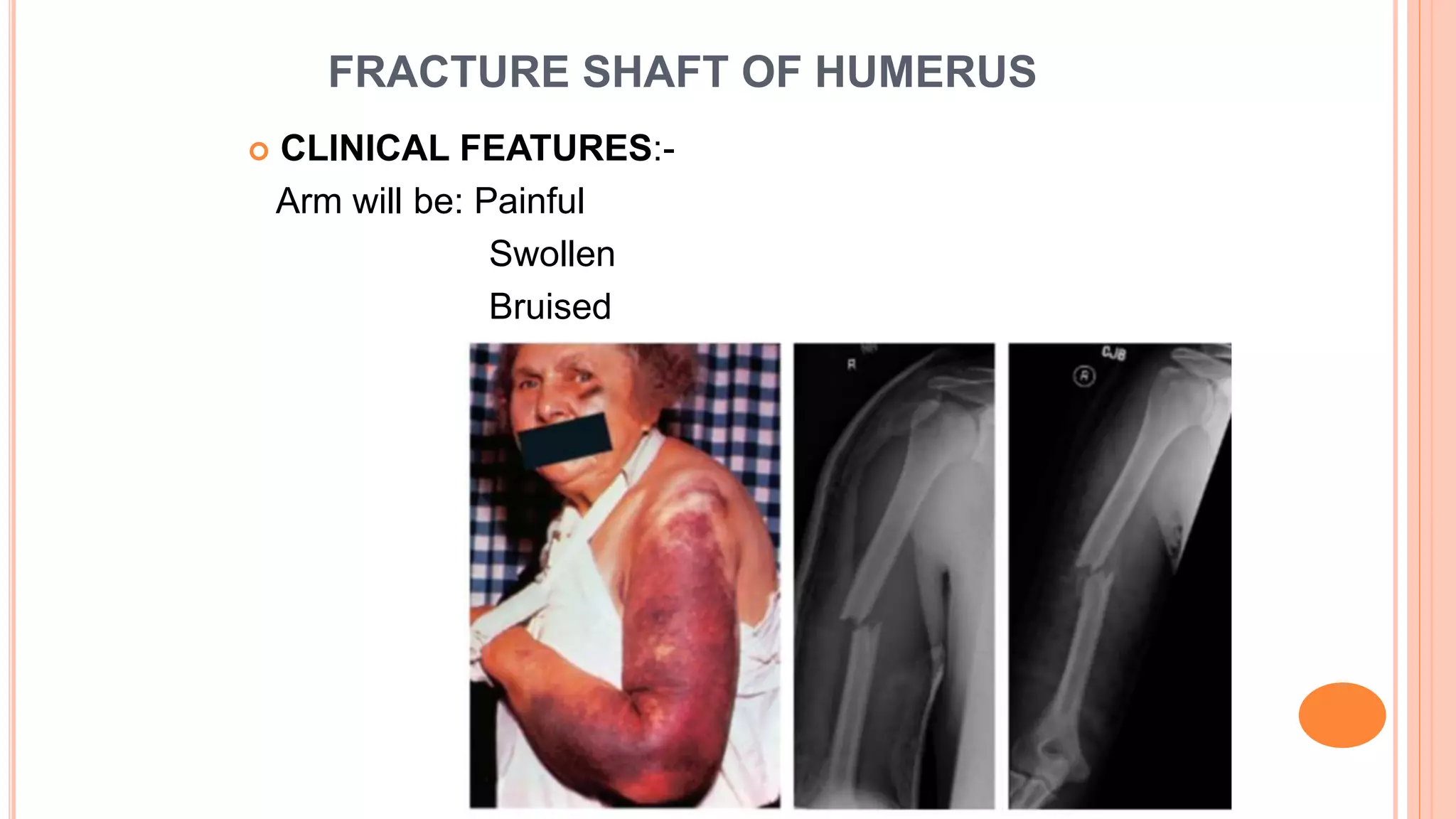 Shaft of humerus fracture | PPTX