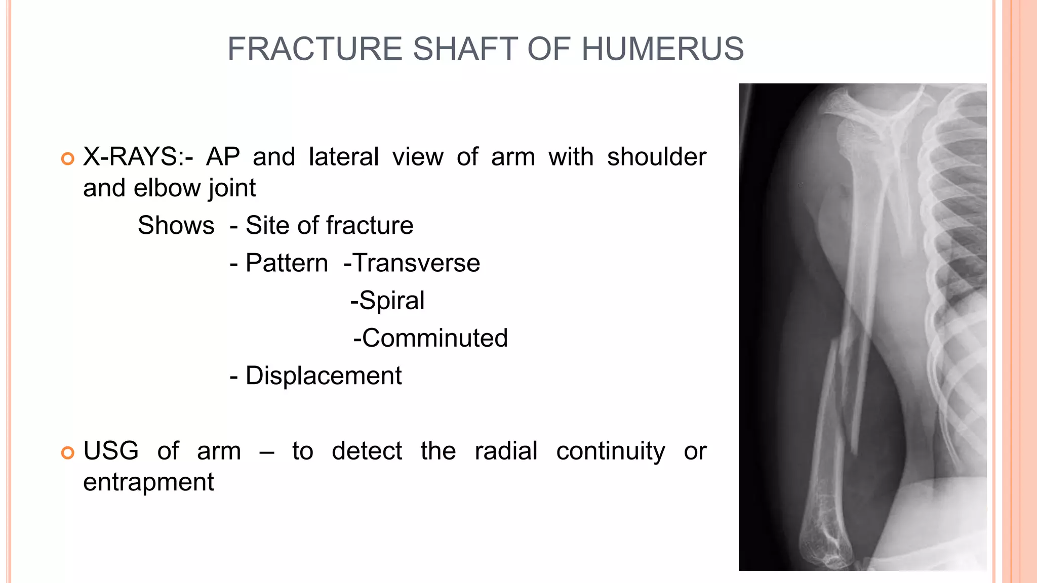 Shaft of humerus fracture | PPTX