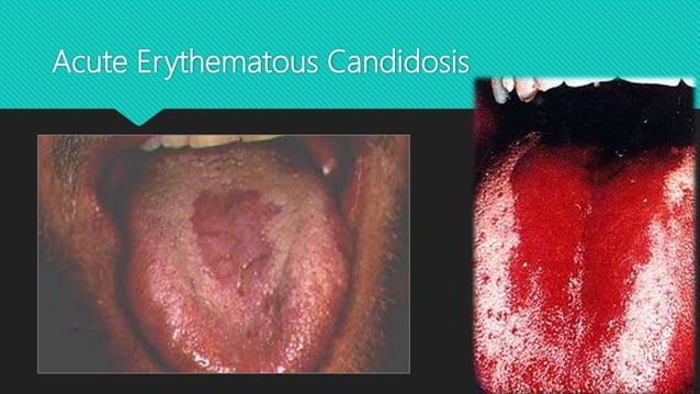 Fungal Infections of Oral Mucosa | PPT