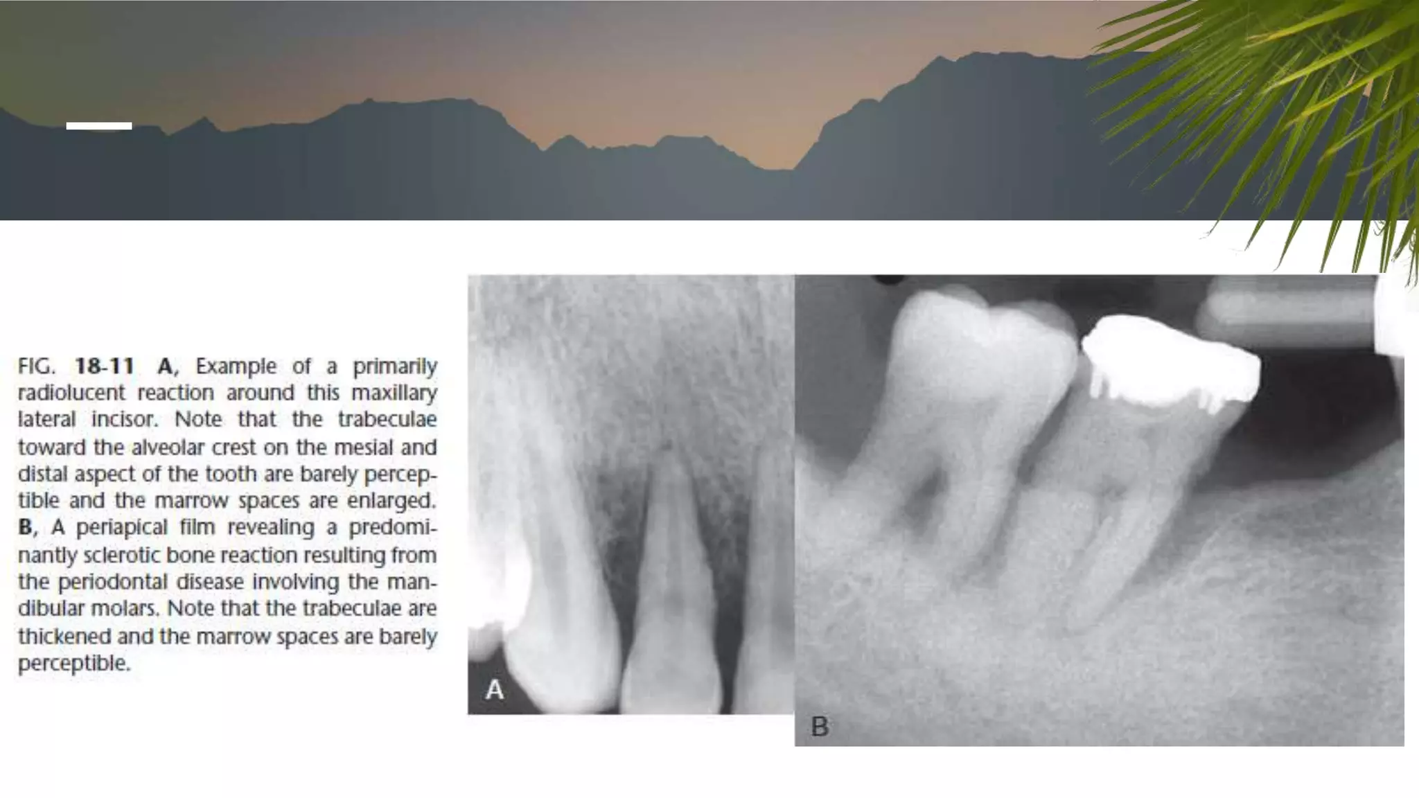 Radiographic Interpretation of Periodontal Diseases | PPTX
