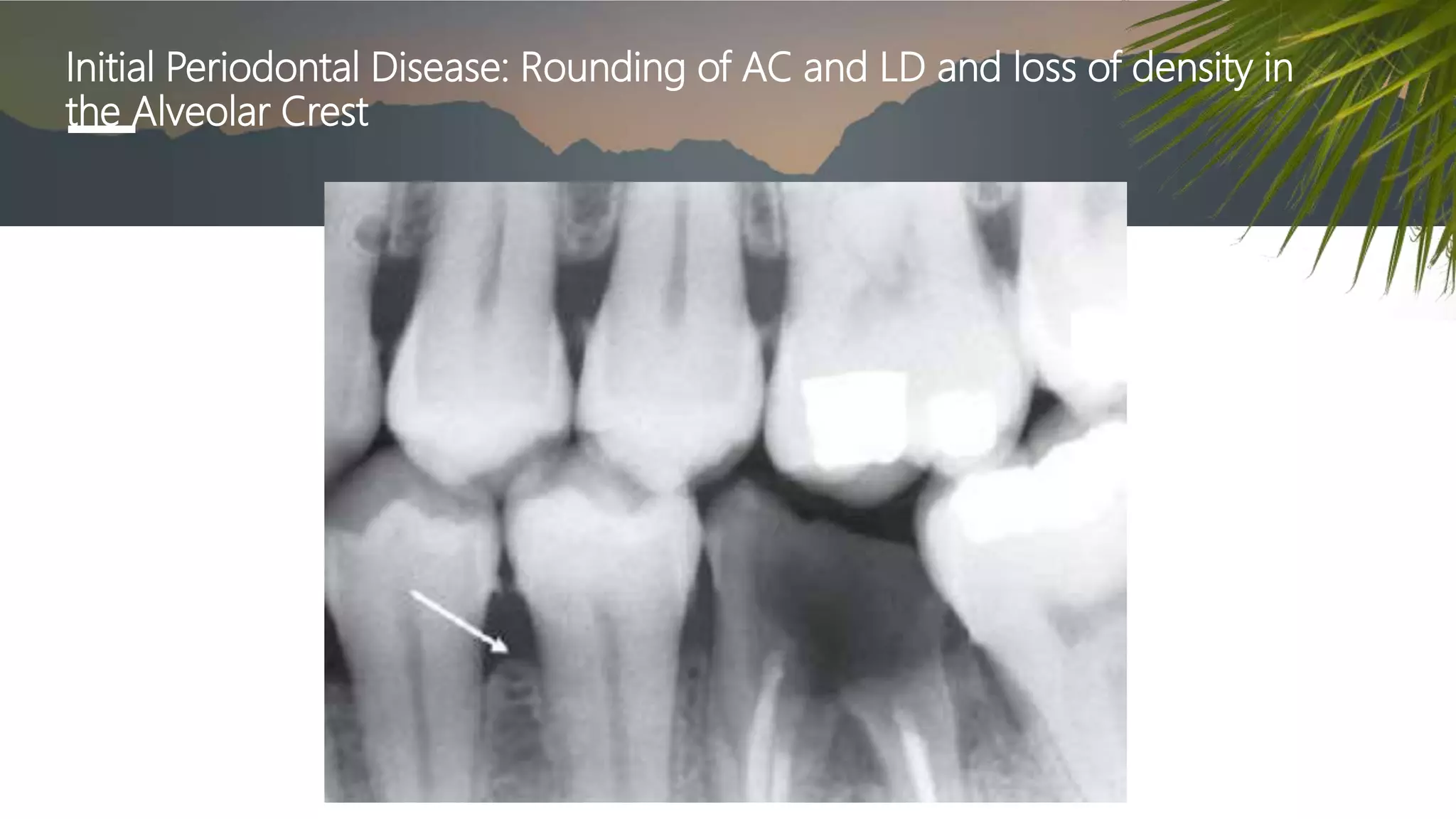Radiographic Interpretation of Periodontal Diseases | PPTX