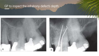 Radiographic Interpretation of Periodontal Diseases | PPTX