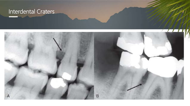 Radiographic Interpretation of Periodontal Diseases | PPTX | Dental ...