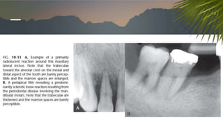 Radiographic Interpretation of Periodontal Diseases | PPTX