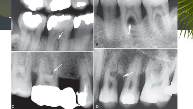 Radiographic Interpretation of Periodontal Diseases | PPTX | Dental ...