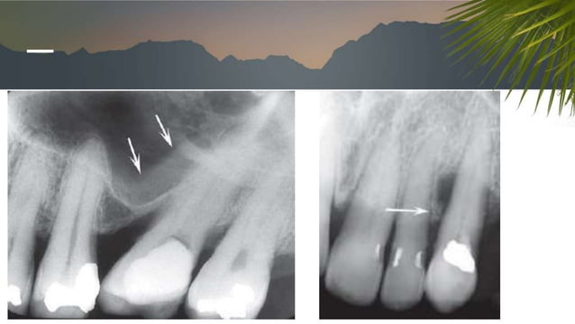 Radiographic Interpretation of Periodontal Diseases | PPTX | Dental ...