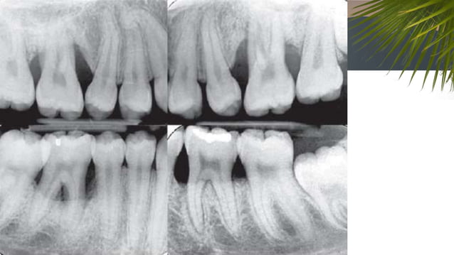 Radiographic Interpretation of Periodontal Diseases | PPTX | Dental ...