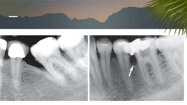 Radiographic Interpretation of Periodontal Diseases | PPTX | Dental ...
