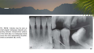 Radiographic Interpretation of Periodontal Diseases | PPTX