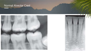 Radiographic Interpretation of Periodontal Diseases | PPTX