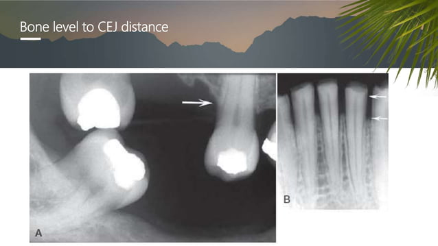 Radiographic Interpretation of Periodontal Diseases | PPTX | Dental ...