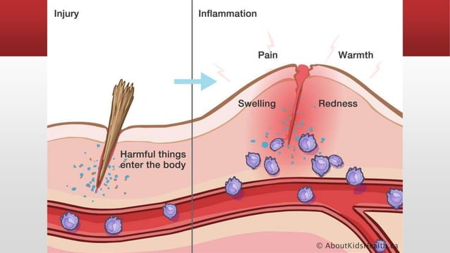 Basic Features of Inflammation and Repair | PPT