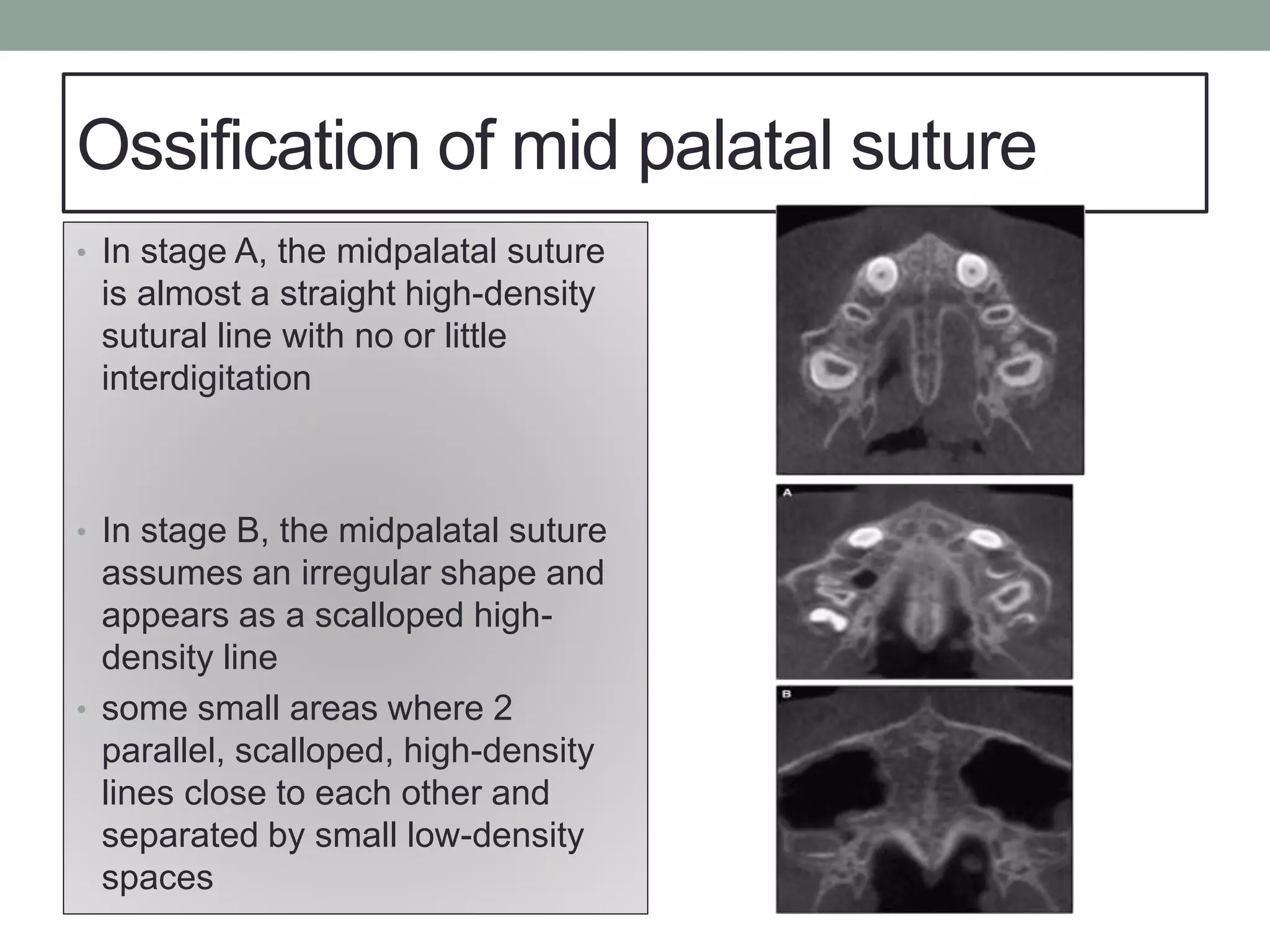 RAPID MAXILLARY EXPANSION VS SLOW MAXILLARY EXPANSION | PPTX