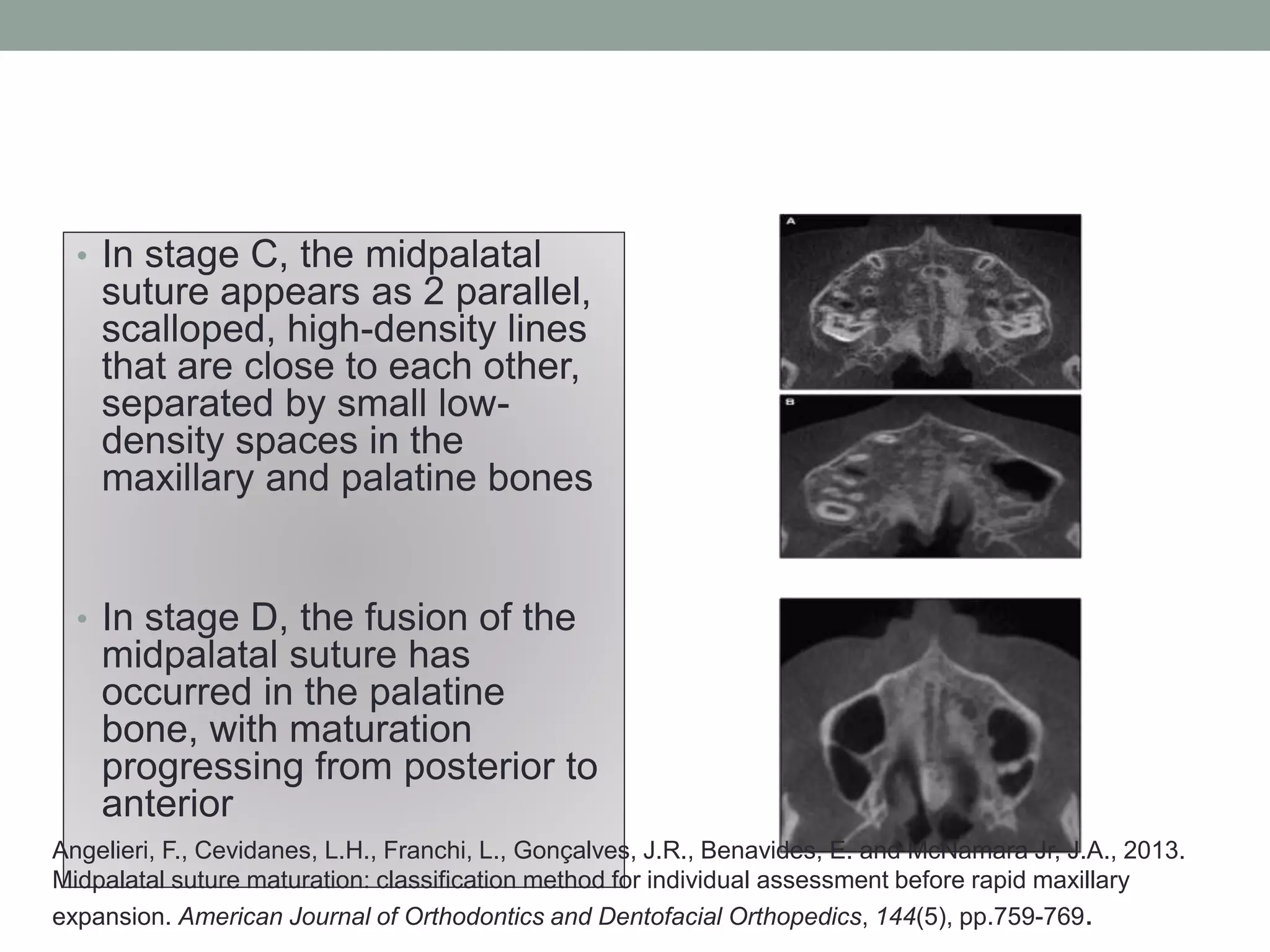 RAPID MAXILLARY EXPANSION VS SLOW MAXILLARY EXPANSION | PPTX