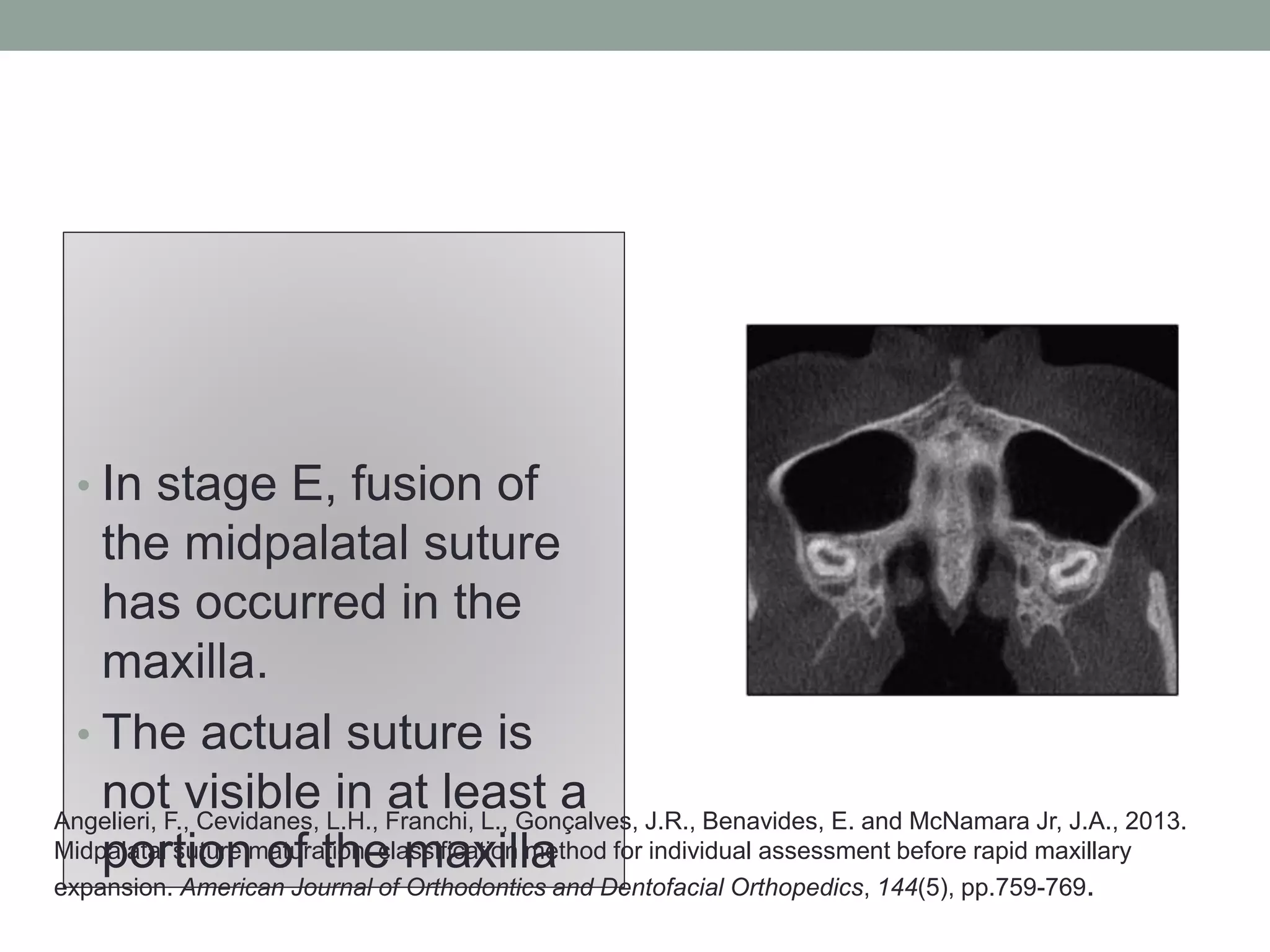 RAPID MAXILLARY EXPANSION VS SLOW MAXILLARY EXPANSION | PPTX