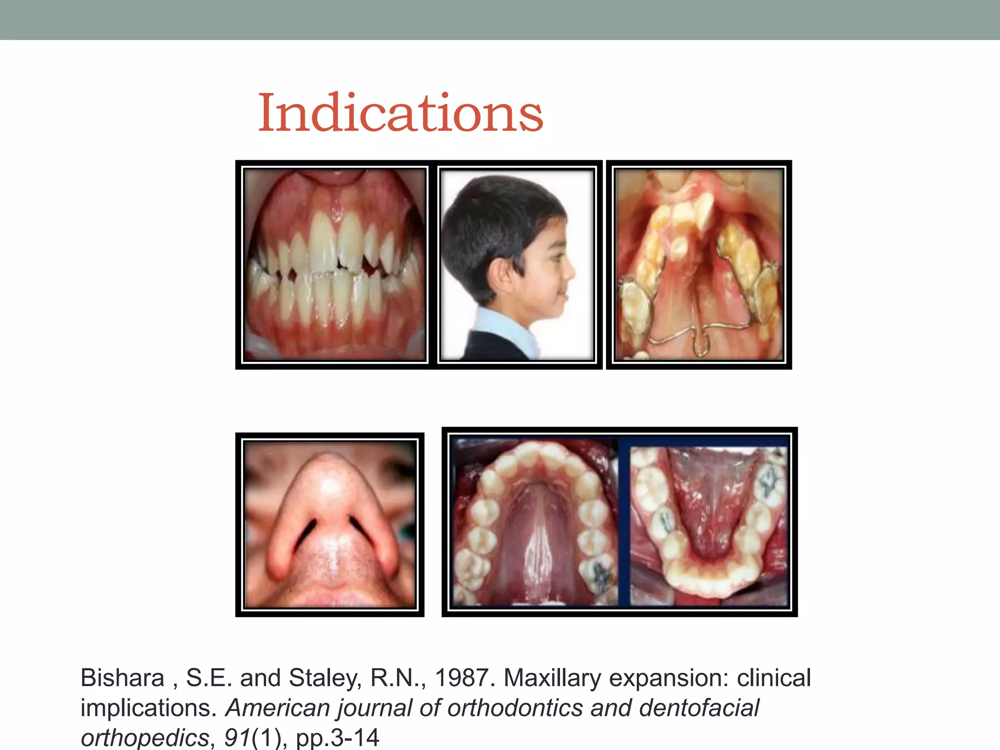 RAPID MAXILLARY EXPANSION VS SLOW MAXILLARY EXPANSION | PPTX