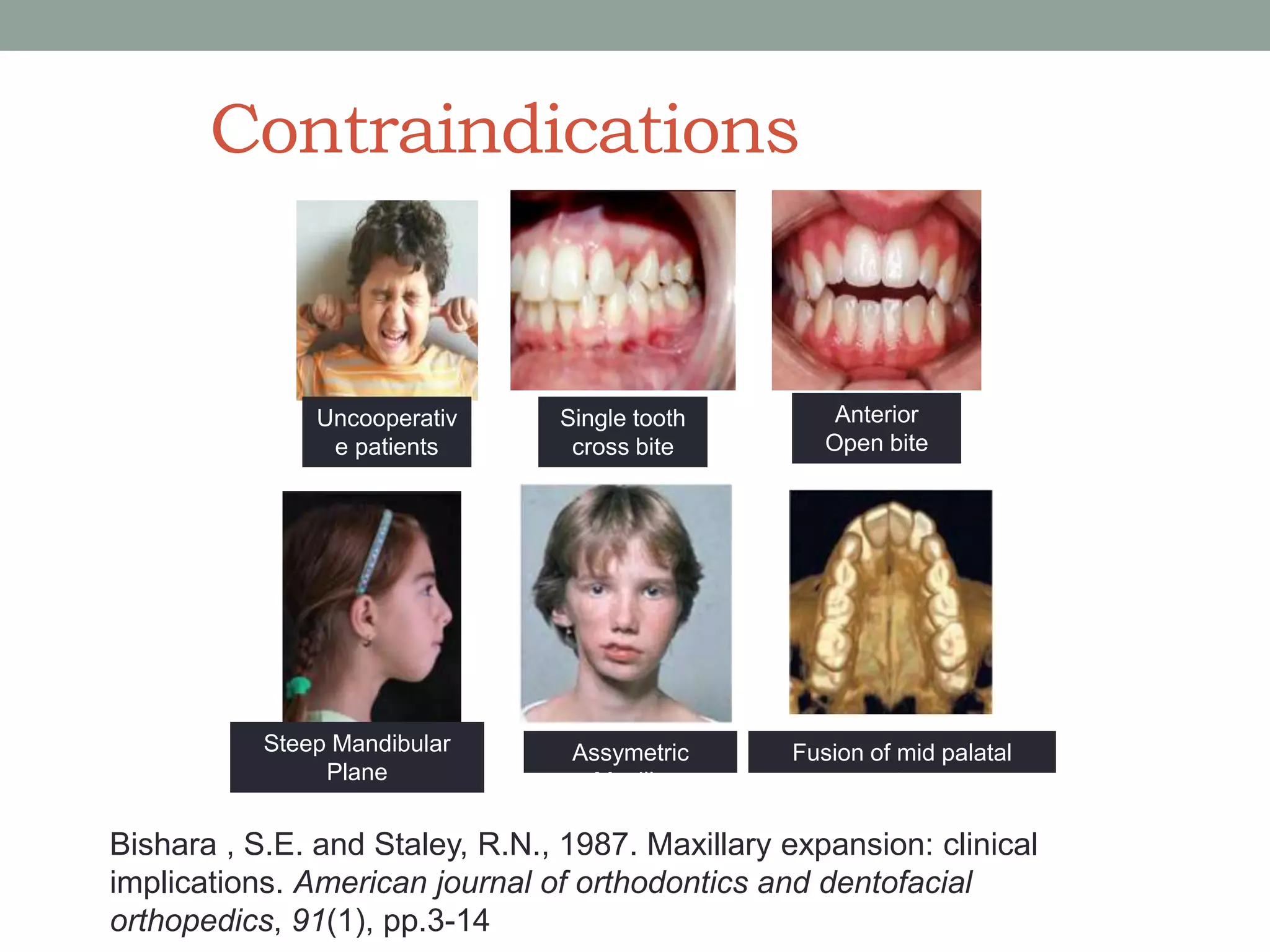 RAPID MAXILLARY EXPANSION VS SLOW MAXILLARY EXPANSION | PPTX
