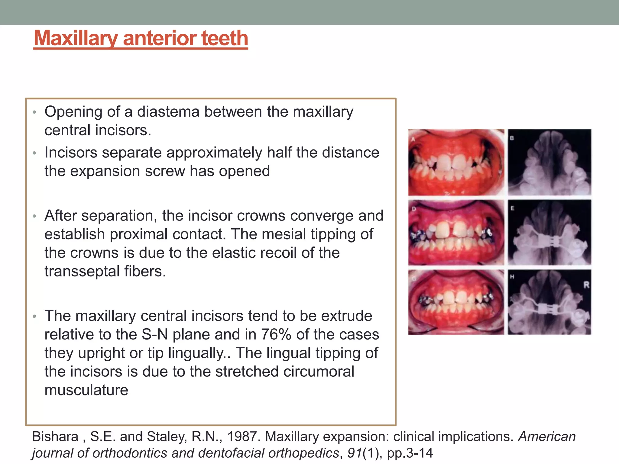 RAPID MAXILLARY EXPANSION VS SLOW MAXILLARY EXPANSION | PPTX
