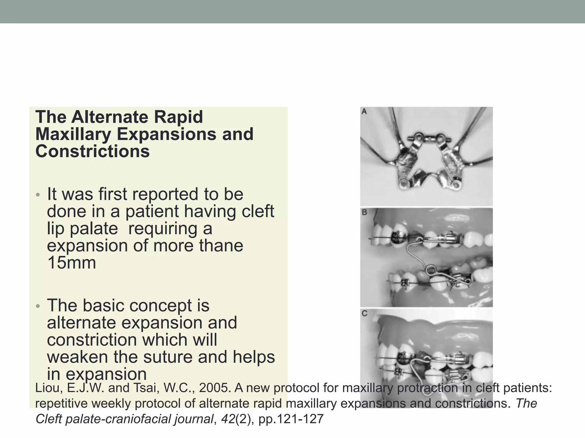 RAPID MAXILLARY EXPANSION VS SLOW MAXILLARY EXPANSION | PPTX