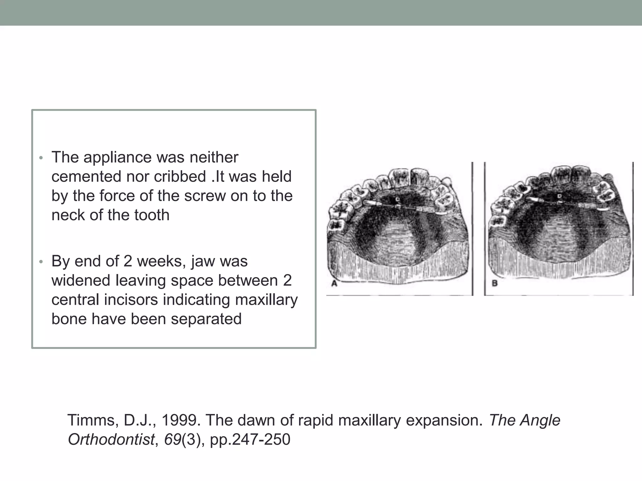 RAPID MAXILLARY EXPANSION VS SLOW MAXILLARY EXPANSION | PPTX