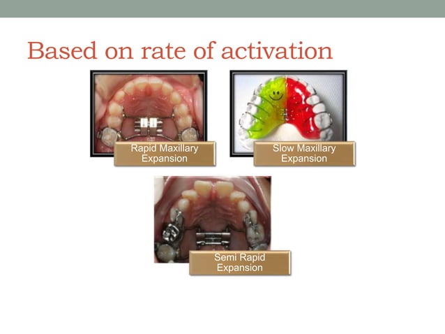 RAPID MAXILLARY EXPANSION VS SLOW MAXILLARY EXPANSION | PPTX