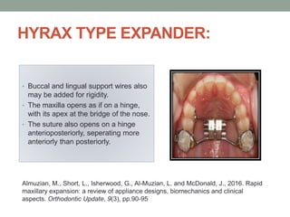 Hyrax Appliance Rapid Maxillary Expansion