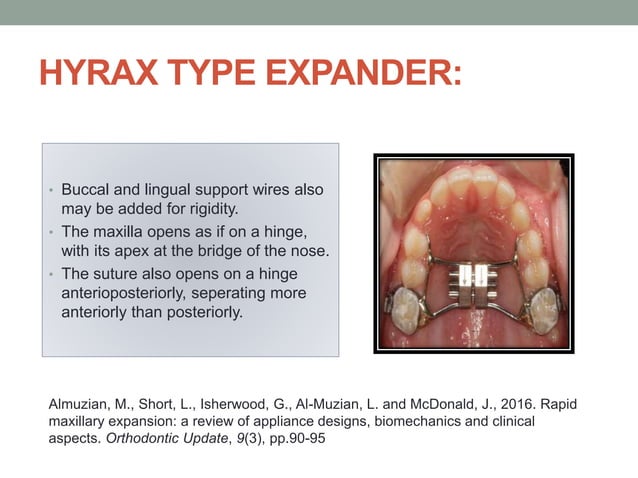 RAPID MAXILLARY EXPANSION VS SLOW MAXILLARY EXPANSION | PPTX
